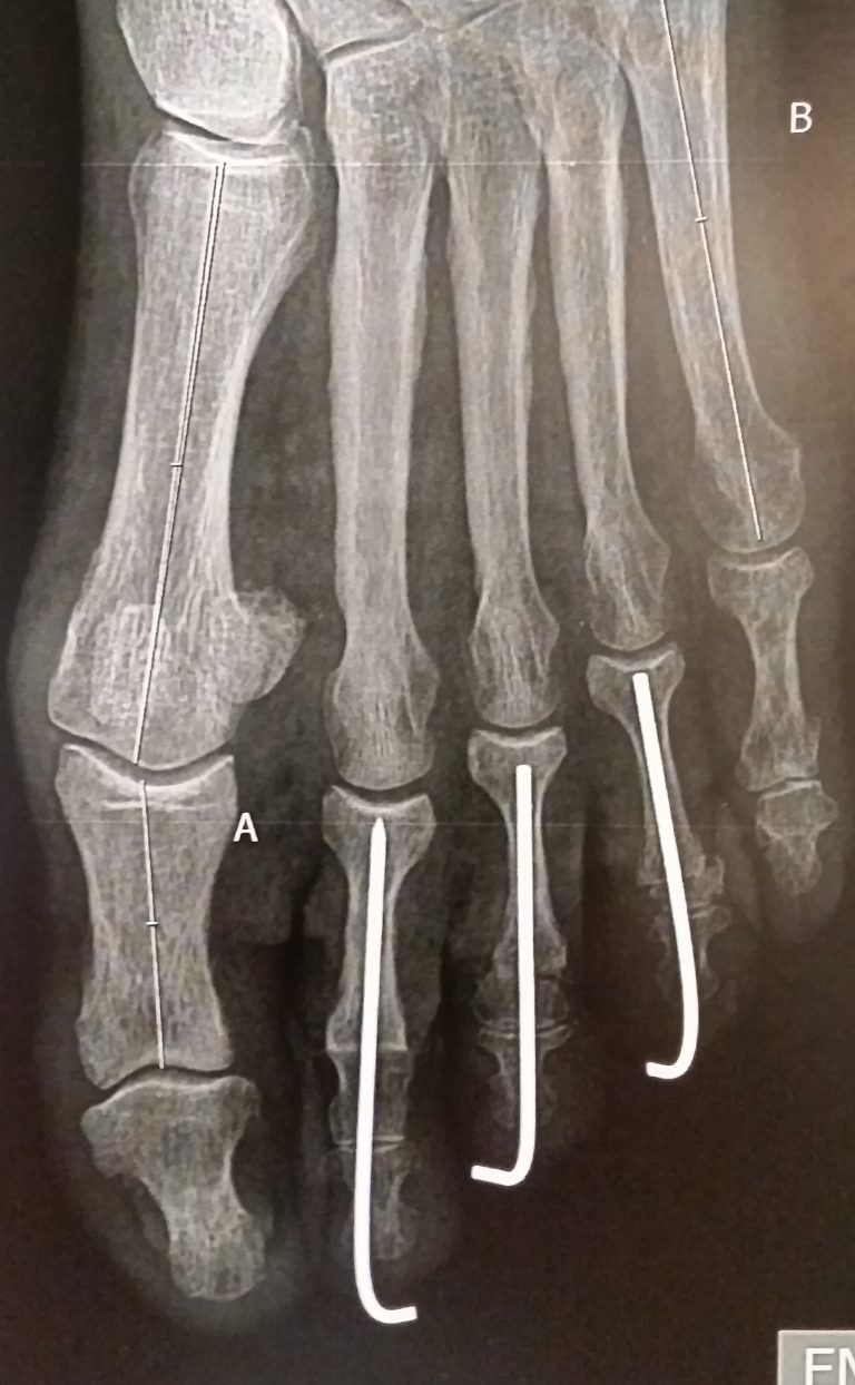 Orteils en griffe - Chirurgie-du-Pied.fr