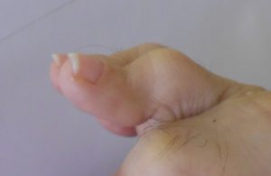 Orteils en griffe - Chirurgie-du-Pied.fr