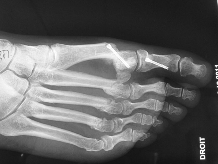 Hyper-appui sous l’avant-pied : ce n’est pas un Morton ! Technique DMMO